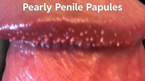 Genital Spots Know The Difference Male R Genitalhealth