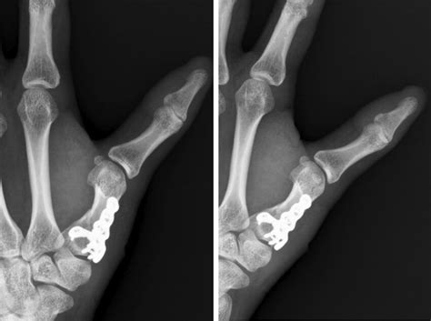 Pod 20 Orif With A Hook Embracing Plate With Excellent Radiologic Download Scientific Diagram