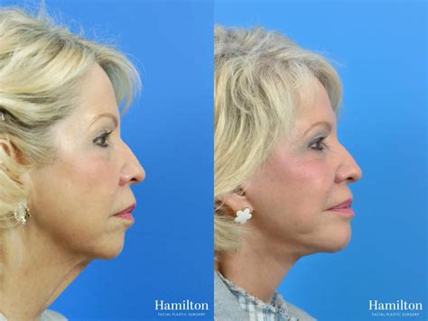 Chin Augmentation Before And After Gallery
