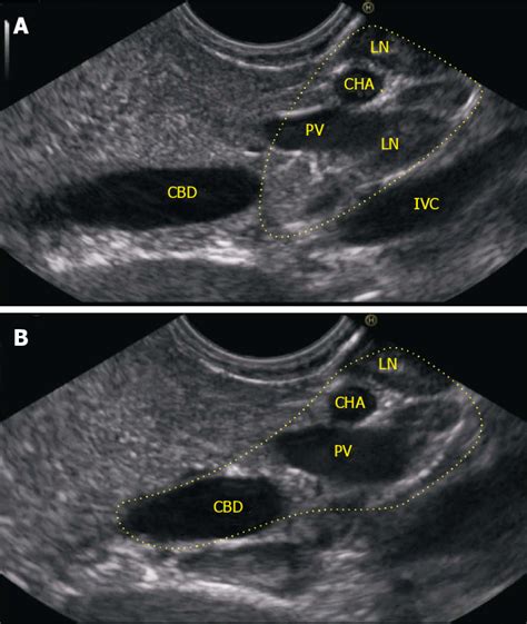 Figure 17 From Imaging Of Common Bile Duct By Linear Endoscopic