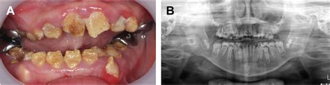 Developmental And Acquired Abnormalities Of The Teeth Dental Clinics