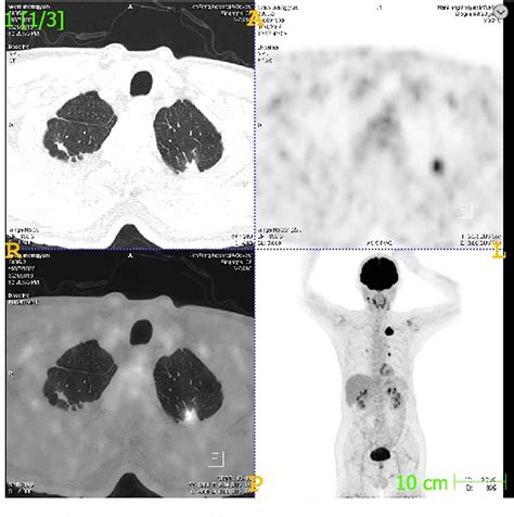 Figure 1 From A Deep Learning Based Ct Image Analytics Protocol To Identify Lung Adenocarcinoma
