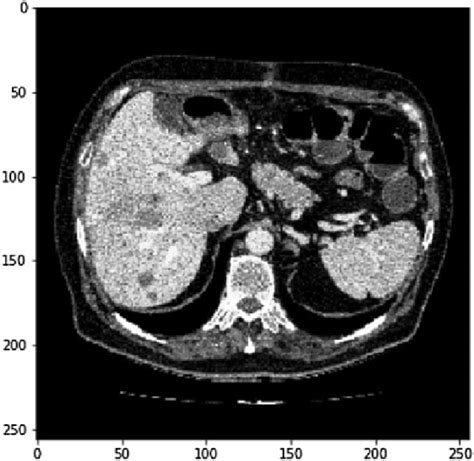 CT Slice Of The First Random Sample Before Liver Segmentation