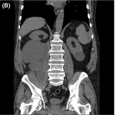 Histopathological Of Mucinous Appendiceal Neoplasm Download Scientific Diagram