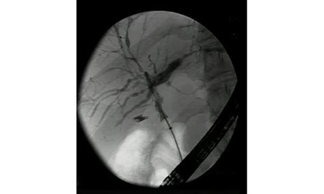 Topic Systemic Therapy For Advanced Cholangiocarcinoma New Options On