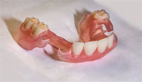 Difference Between Cast Partial Denture And Removable Partial Denture