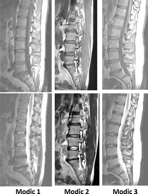 O Que Significa Alteração Degenerativa Modic Tipo Ii Retoedu