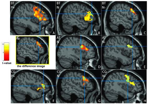 activation of the frontal cortex in patients before bt a c after