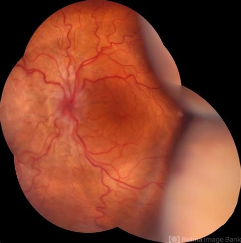 Hypotony Maculopathy Best Management Strategies