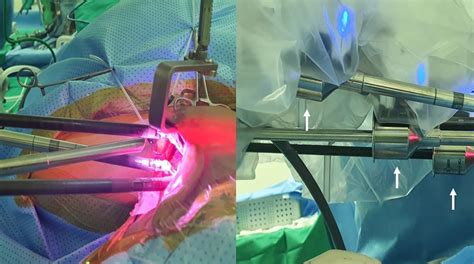 갑상선 로봇 수술 후이개 접근법 안정성·유용성 확인 네이버 블로그