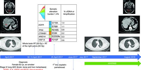 A Case Report Of A Patient With An Uncommon Double Egfr Mutation Download Scientific Diagram