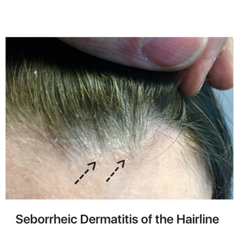 Seborrheic Dermatitis Hair Loss