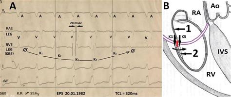 Focused Local Electrograms Leg Showing Right Atrial And Accessory Download Scientific