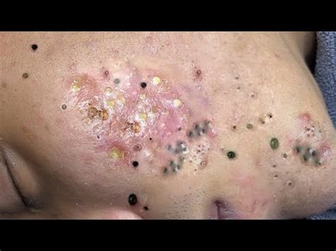 𝘼𝙘𝙝𝙞𝙚𝙫𝙚 𝙄𝙣𝙣𝙚𝙧 𝙋𝙚𝙖𝙘𝙚 𝙬𝙞𝙩𝙝 𝙏𝙝𝙚𝙨𝙚 𝙁𝙖𝙘𝙞𝙖𝙡 𝘾𝙡𝙚𝙖𝙣𝙨𝙞𝙣𝙜 𝙈𝙚𝙩𝙝𝙤𝙙𝙨 YouTube