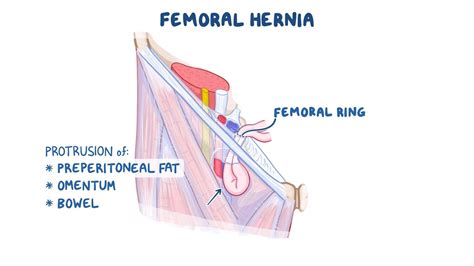 Femoral Hernia Anatomy Femoral Hernia Image