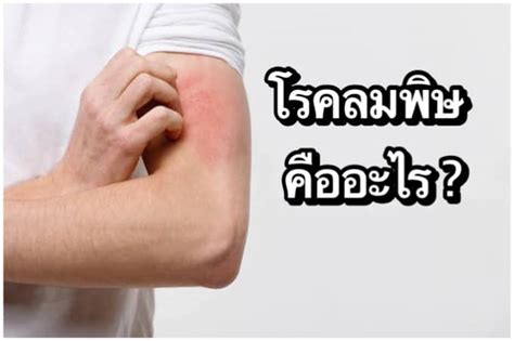 โรคลมพิษ คืออะไร โรคลมพิษ หรือ ผื่นลมพิษ Urticaria มีลักษณะเป็นผื่น
