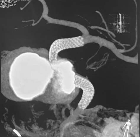 Four Vessel Cerebral Dsa Showing Pipeline Fd Placement For A Cca Aneurysm Download Scientific