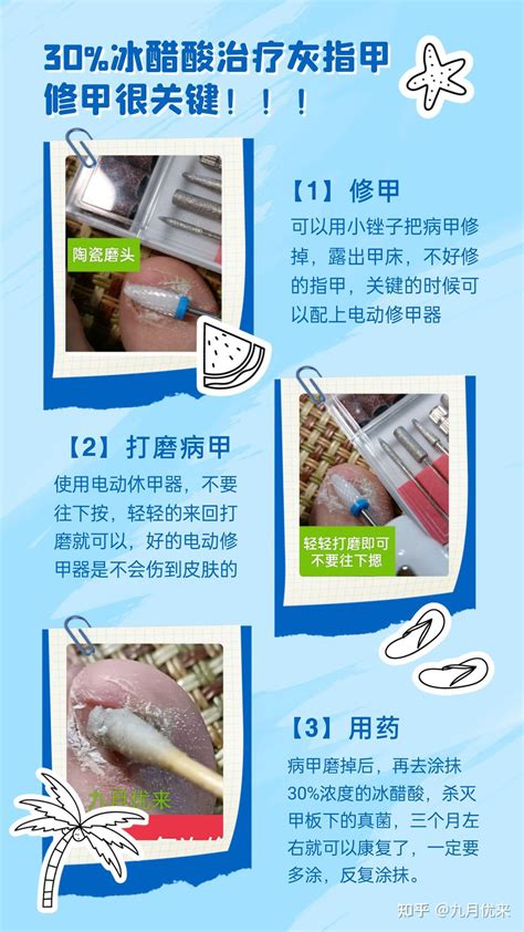 治疗灰指甲的关键在于修甲和脱甲！这2点做不到，甲板下的真菌就清理不掉，怎能治好灰指甲？6年的实战经验分享！灰指甲、脚气、手足癣到底应该怎样根除