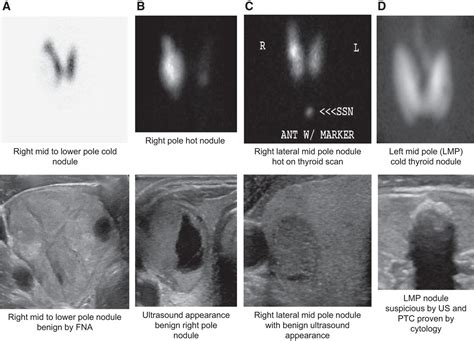 Thyroid Nodule Imaging A Novel Ultrasound Image Diagnostic Method For