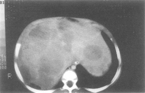 Abdominal Ct Scan Showing Multiple Cystic Lesions In The Liver