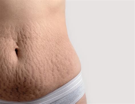 How To Prevent Stretch Marks During Pregnancy Currently Jess