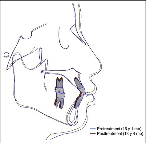 Figure 14 From Treatment Of A Mandibular Functional Shift In An