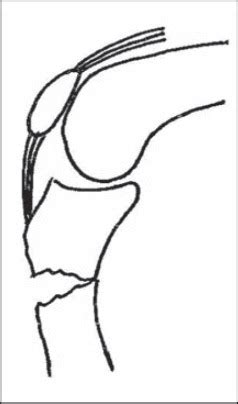 Proximal Third Tibia Fracture Trauma Orthobullets