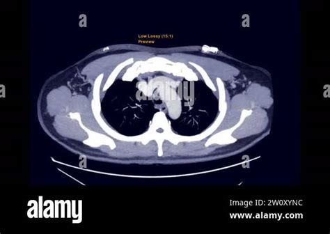 Cta For Pe Or Pulmonary Embolism Ct Chest With Contrast Media Agent
