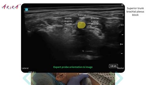 Superior Trunk Block