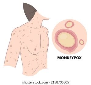 Skin Scabs Vector Images Stock Photos Vectors Shutterstock