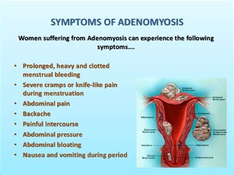 Adenomyosis As Related To Bleeding Pictures