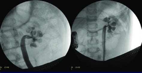 The Retrograde Pyelogram Revealed High Insertion Ureteropelvic Download Scientific Diagram