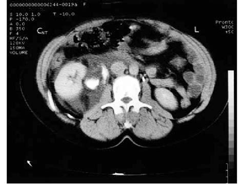 Contrast Enhanced Ct Demonstrated The Localization Of Rupture Of The Download Scientific
