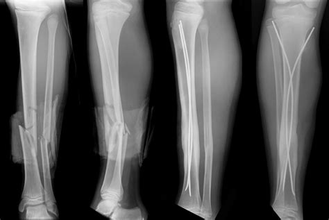 Open Fracture X Ray