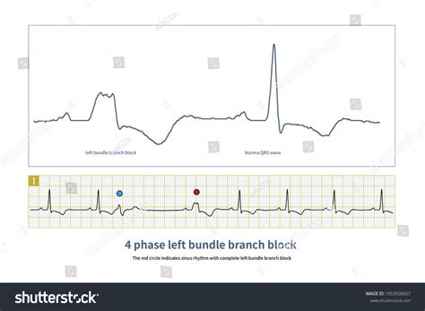 When Complete Left Bundle Branch Block Stock Illustration Shutterstock