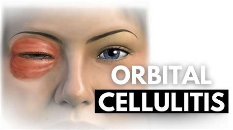 Orbital Cellulitis A Comprehensive Guide To Diagnosis And Management
