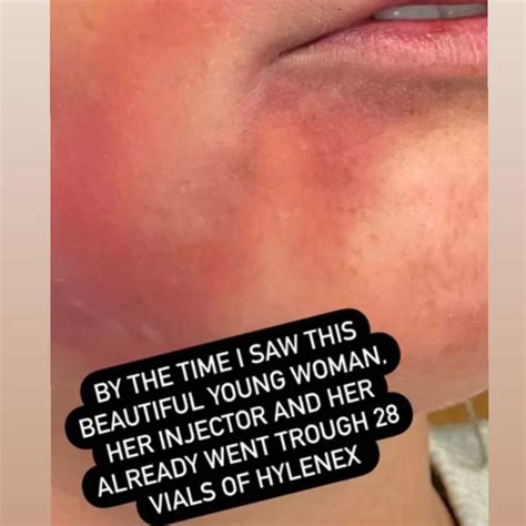 Dermal Filler Occlusion Dr Stella To The Rescue With Clarius Ultrasound Clarius