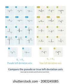 44 Left Axis Deviation Images Stock Photos Vectors Shutterstock