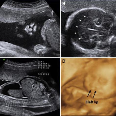 A G Banded Chromosome 7 And Del7q33 B Array Cgh Analysis With Download Scientific