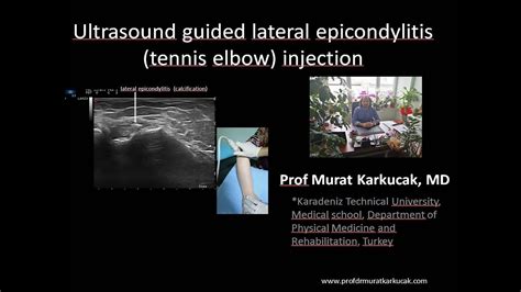 Lateral Epicondylitis Ecrb At Eva Gloucester Blog