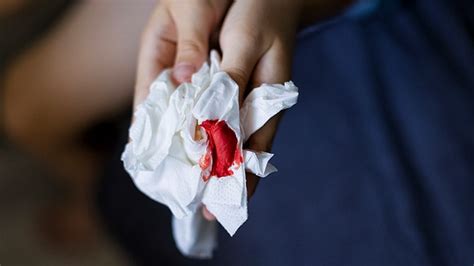 EMA Approves Issue VIII Deficiency Clotting Drug Daily Medical News