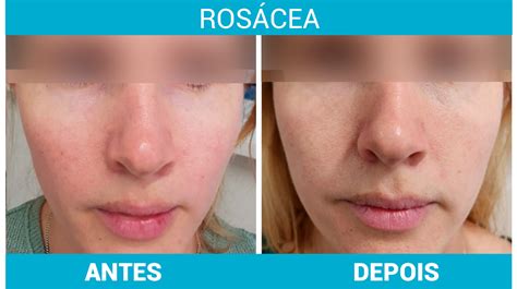 An Overview Of Rosacea Treatments Dr Szerman Rosaceas Different Types Symptoms Causes