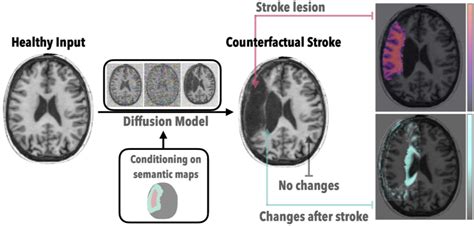 [논문 리뷰] Mededit Counterfactual Diffusion Based Image Editing On Brain Mri