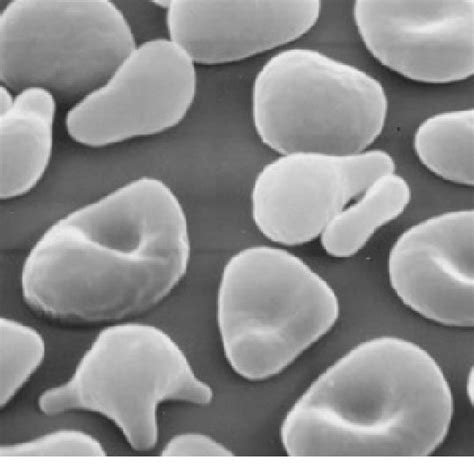 PDF Disorders Of The Red Cell Membrane