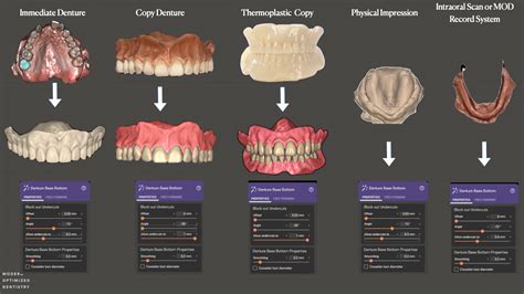 Exocad Level 3 Denture Design The Mod Institute