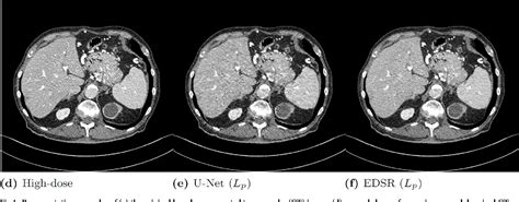 figure 1 from wavelet subband specific learning for low dose computed