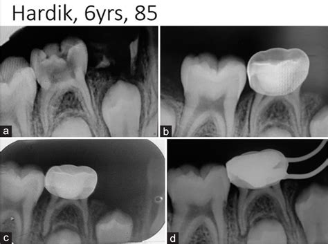 Is Clindamycin Modified Triple Antibiotic Paste Better Than Iodoform