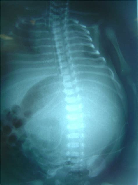 Plain Abdominal X Ray Showing A Large Soft Tissue Mass With