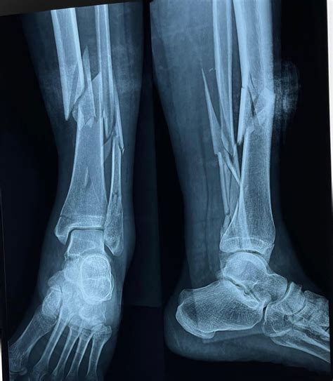 Management Of Ipsilateral Tibia And Fibula Shaft Fracture With
