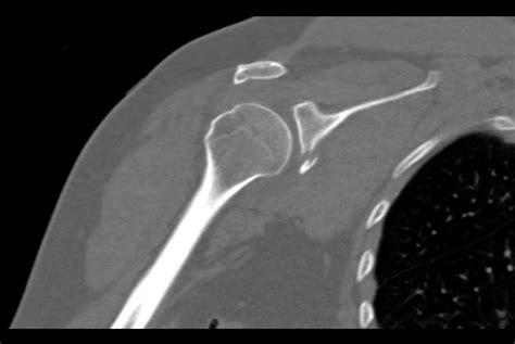 Glenoid Fossa Fracture X Ray At Billy Gamboa Blog